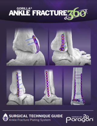 Surgical Technical Guides – Paragon 28