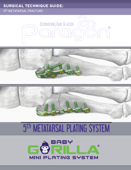 Baby Gorilla® 5th Metatarsal Plating System – Paragon 28