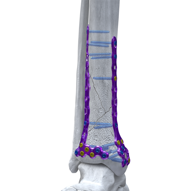 Gorilla® Ankle Fracture Pilon Plating System – Paragon 28