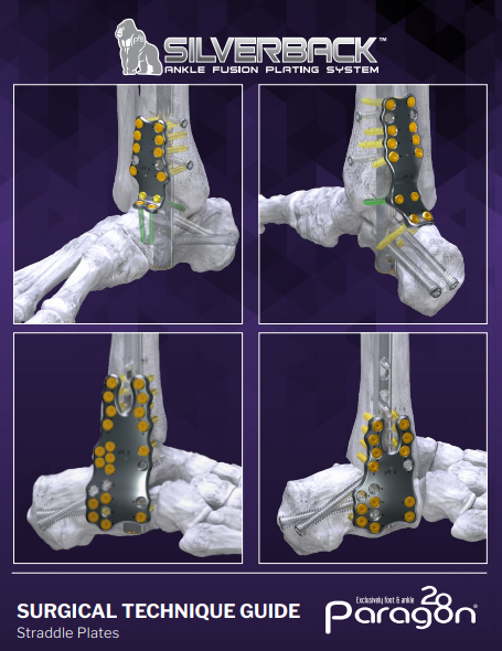 Silverback™ Ankle Fusion Plating System – Paragon 28