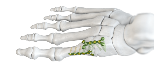 Baby Gorilla® Y-Plates (Single and Double) – Paragon 28