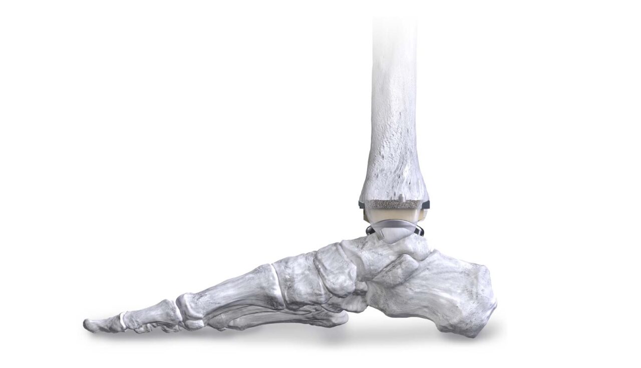 APEX 3D™ Total Ankle Replacement System – Paragon 28