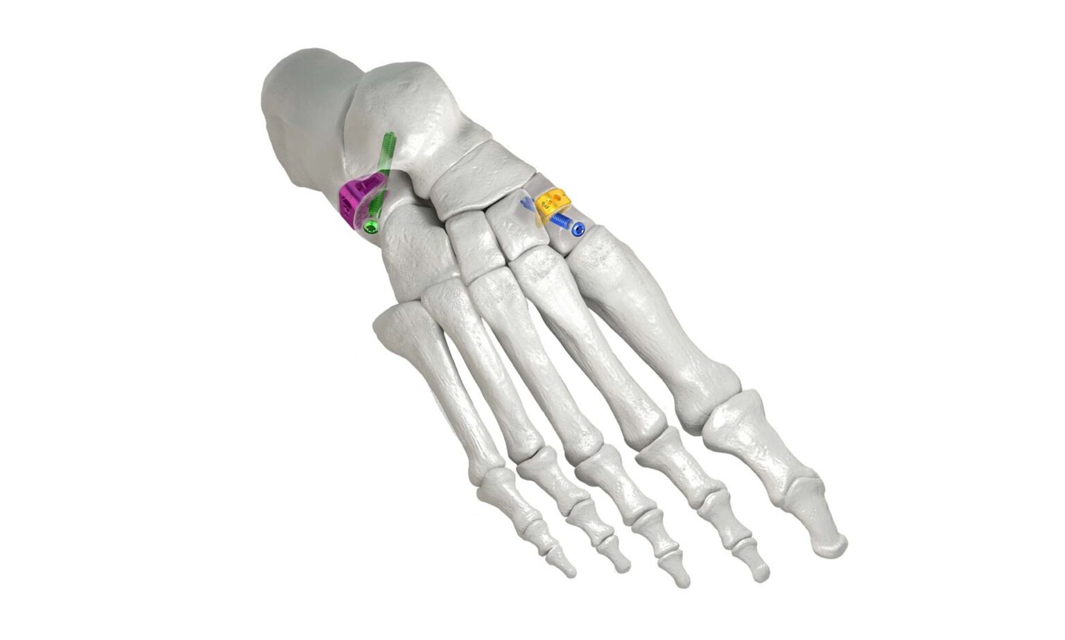TITAN 3-D™ Evans Lateral Column Lengthening Wedge – Paragon 28
