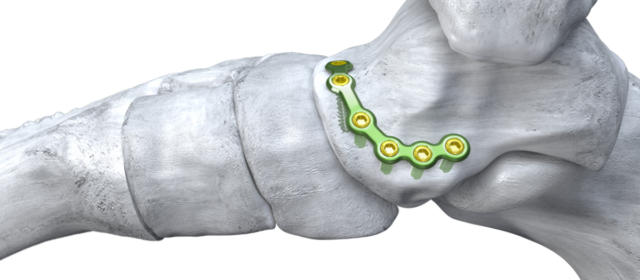 Baby Gorilla® Talar Neck Plates – Paragon 28