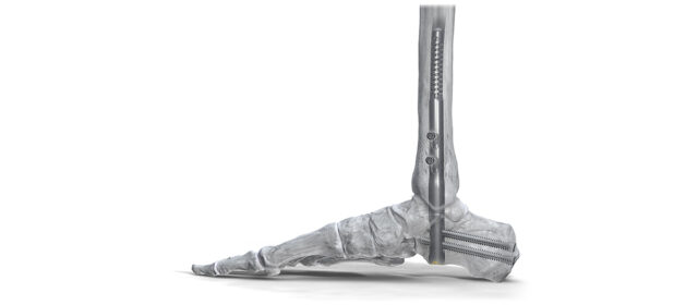 Phantom ActivCore™ Nail – Paragon 28