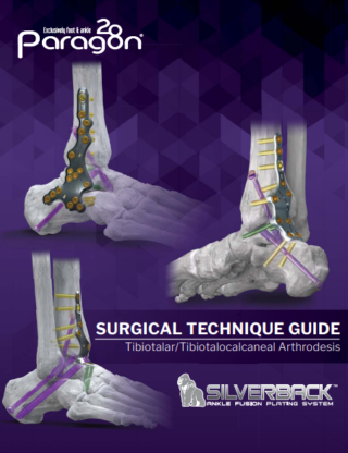 Silverback™ Straddle Ankle Fusion Plating System – Paragon 28