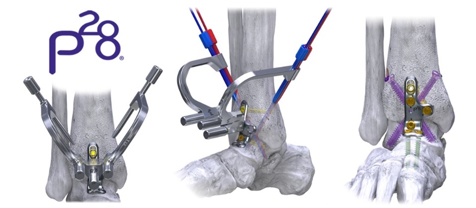 Silverback™ Mini-Open Plating System Launching – Paragon 28