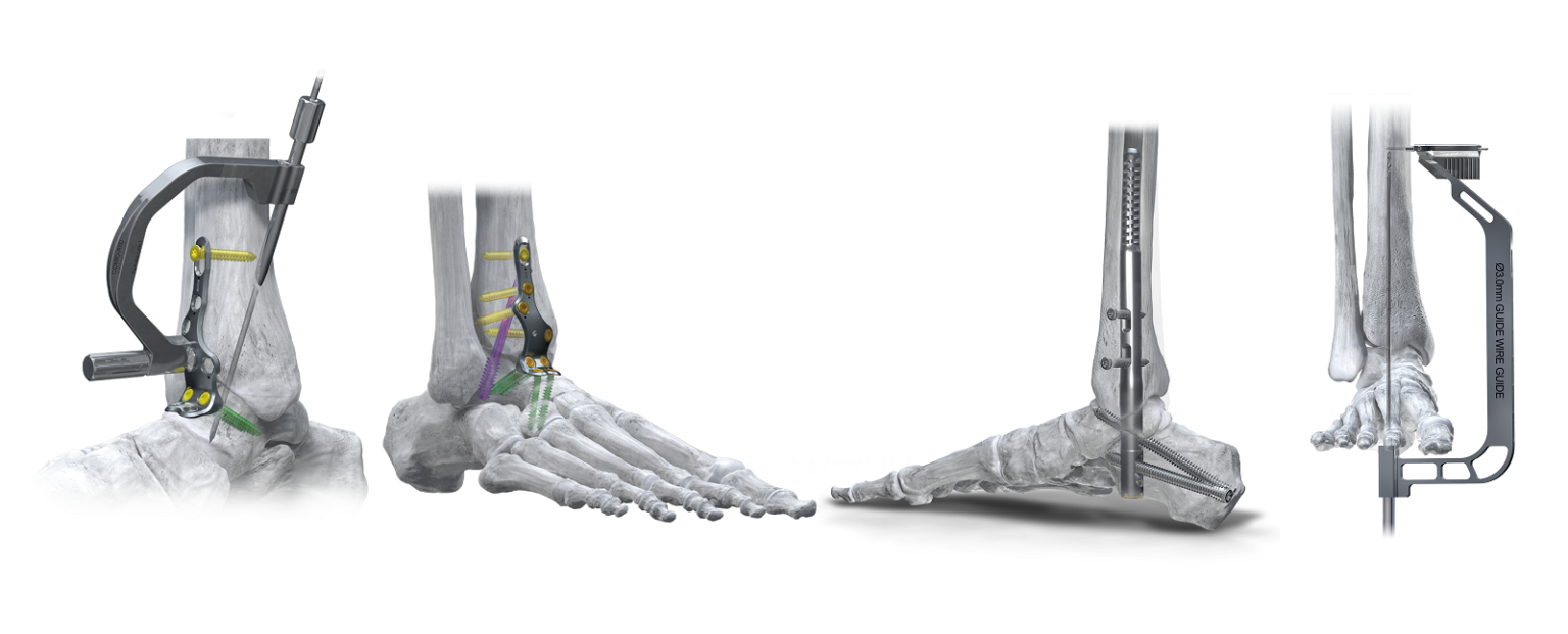 Precision Guided Ankle Fusion Ad Page – Paragon 28