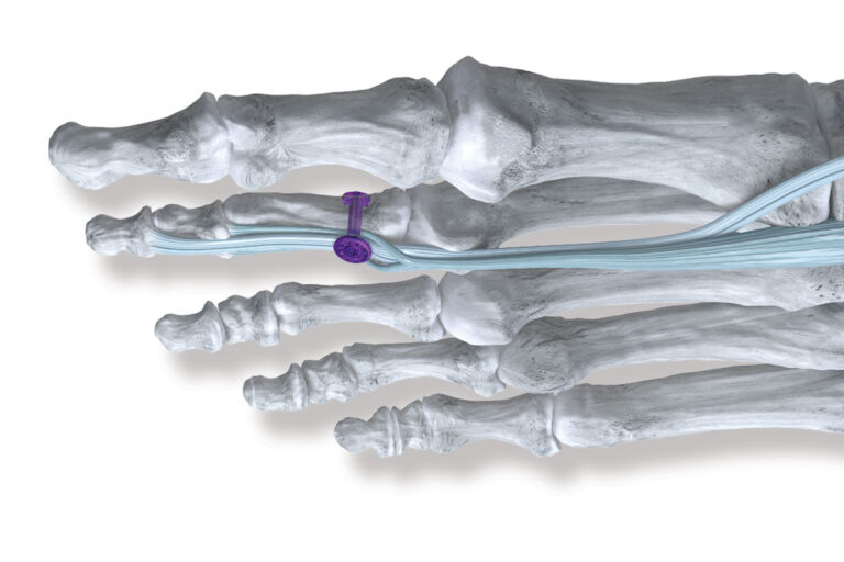 TenoTac® 2.0 Soft Tissue Fixation System – Paragon 28