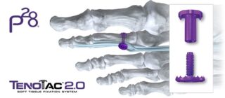 Launch of TenoTac™ 2.0 Soft Tissue Stabilization System – Paragon 28