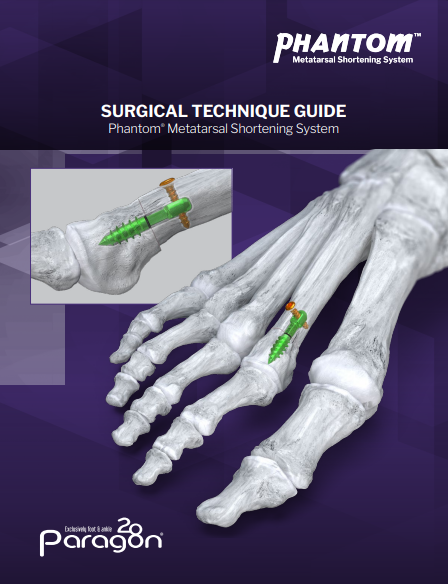 Phantom® Metatarsal Shortening System – Paragon 28