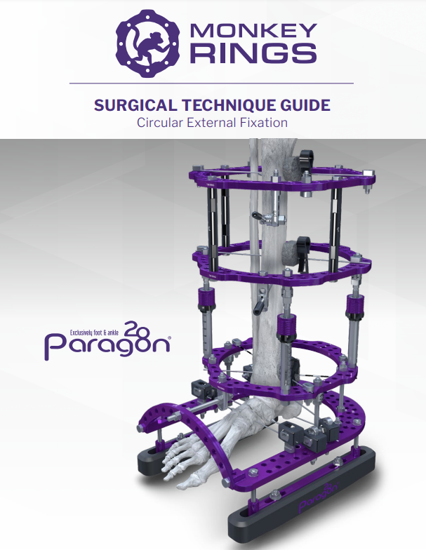Monkey Rings™ External Fixation System – Paragon 28
