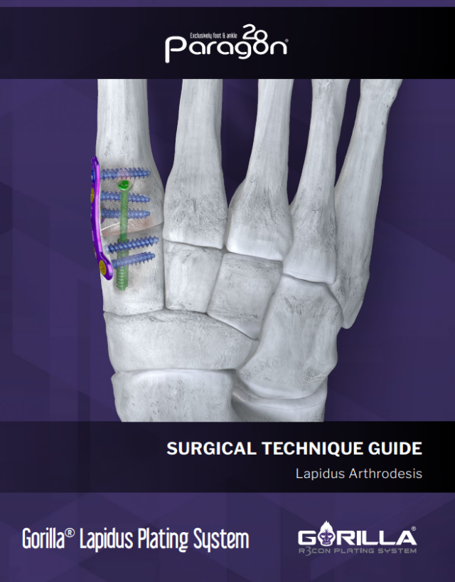 Surgical Technical Guides – Paragon 28