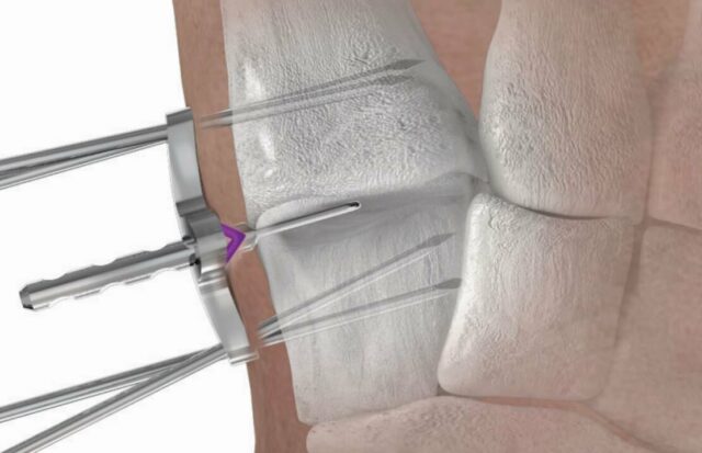 Phantom® Minimally Invasive Surgery (MIS) System – Paragon 28