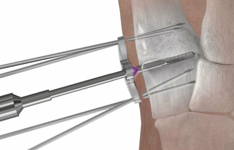 Phantom® Minimally Invasive Surgery (MIS) System – Paragon 28