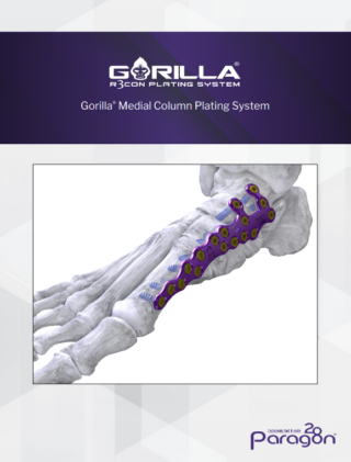 Gorilla® Medial Column Plating System – Paragon 28