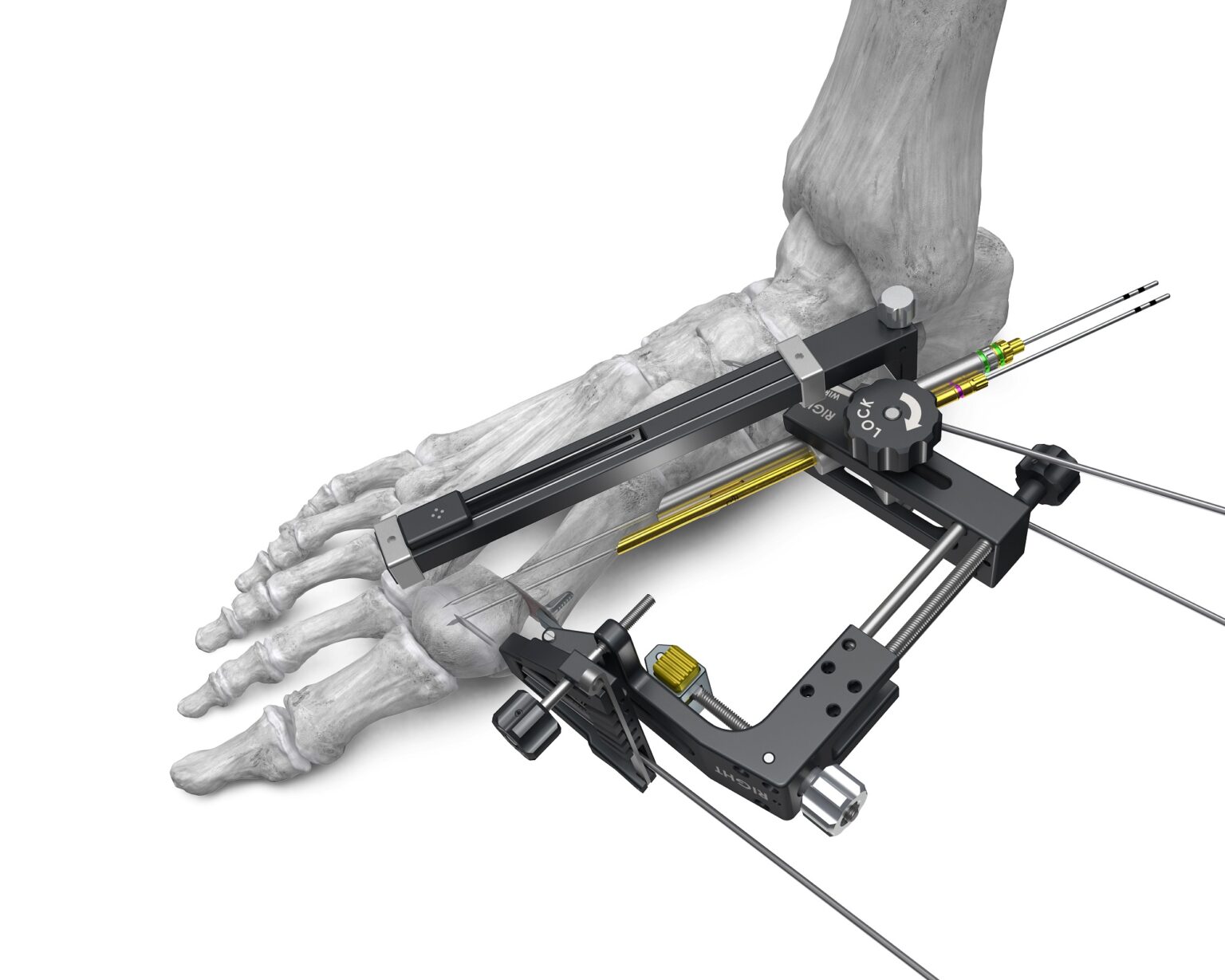 PRECISION® MIS Bunion System – Paragon 28