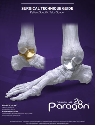 Total Talus Replacement – Paragon 28