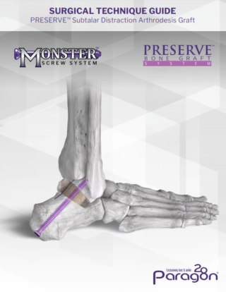PRESERVE™ Subtalar Distraction Arthrodesis Graft – Paragon 28