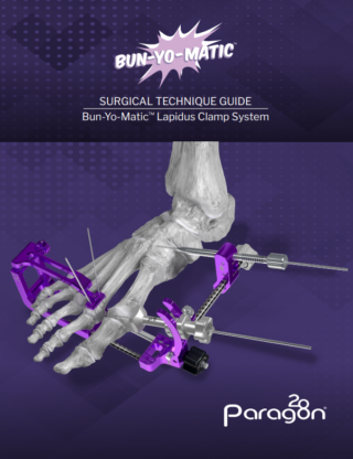 Bun-Yo-Matic™ Lapidus Clamp – Paragon 28