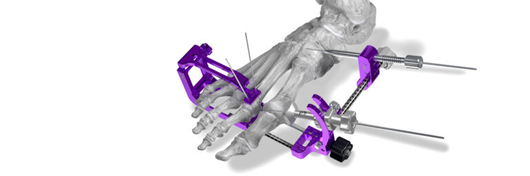 Bun-Yo-Matic™ Lapidus Clamp – Paragon 28