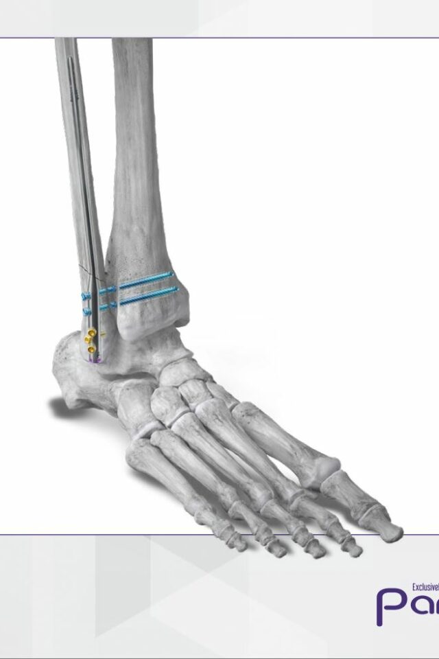 Phantom® Fibula Nail System – Paragon 28