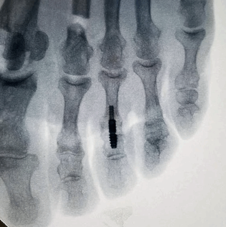 Nextra® CH Cannulated Hammertoe System – Paragon 28