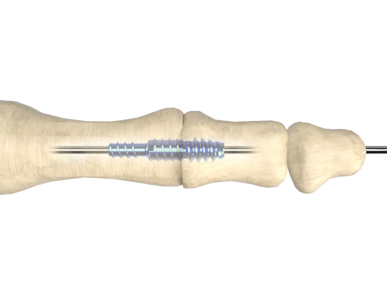 Hammertoe Implants – Paragon 28