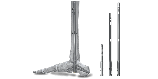 Phantom® TTC Trauma Nail – Paragon 28