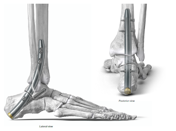 Phantom® Curved Hindfoot Fusion Nail – Paragon 28