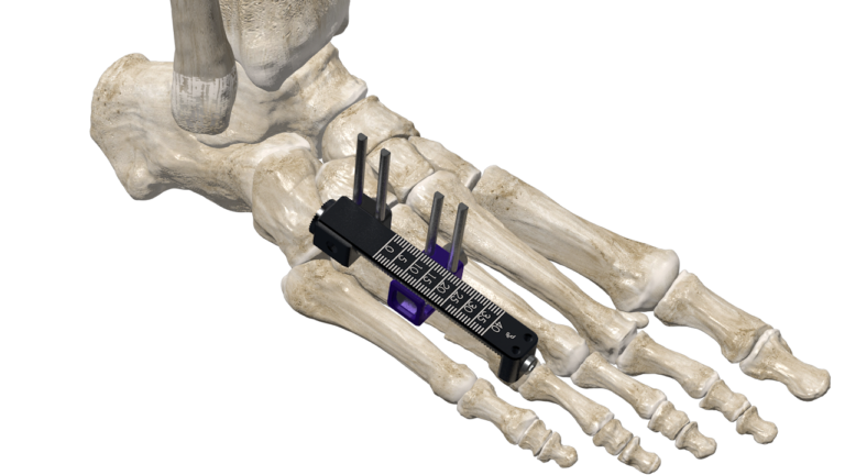 The Brachiator™ Mini External Fixation System – Paragon 28
