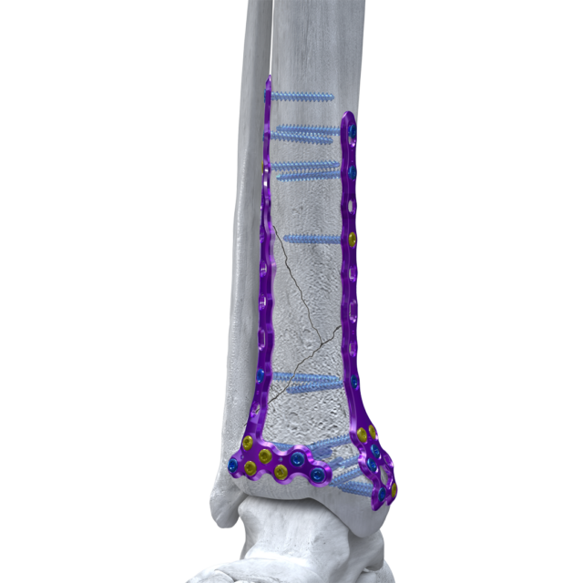 Gorilla® Ankle Fracture Pilon Plating System - Paragon 28