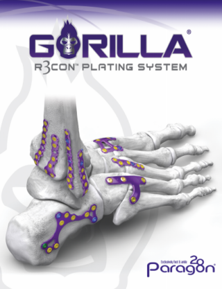 Gorilla® Ankle Fracture Plating System - Paragon 28
