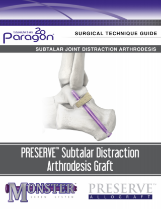 PRESERVE™ Subtalar Distraction Arthrodesis Graft - Paragon 28