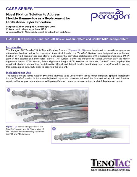 TenoTac® 2.0 Soft Tissue Fixation System - Paragon 28