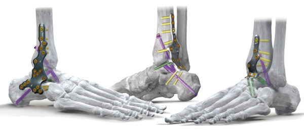 Silverback™ Ankle Fusion Plating System - Paragon 28