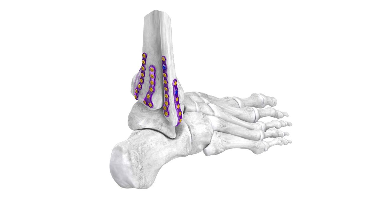 Gorilla® Ankle Fracture Plating System – Paragon 28