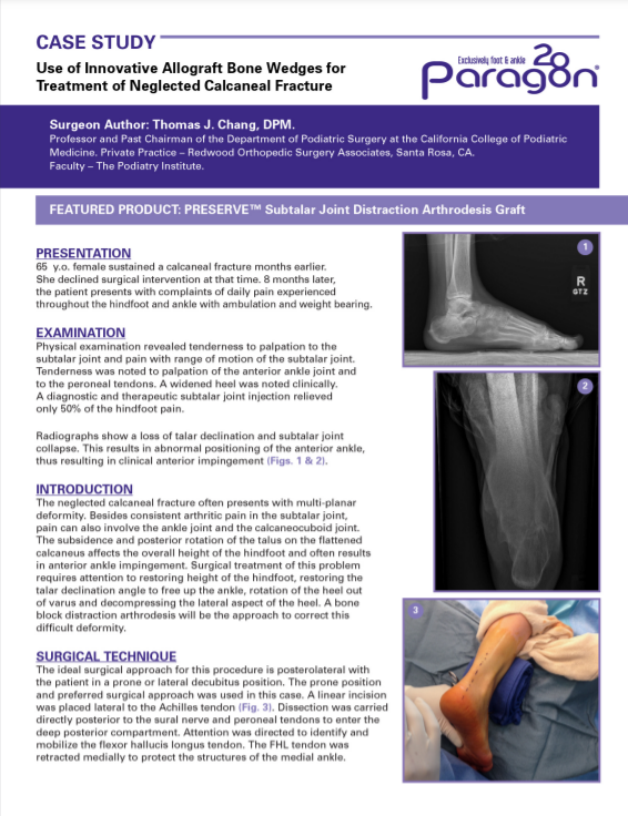 PRESERVE™ Subtalar Distraction Arthrodesis Graft - Paragon 28