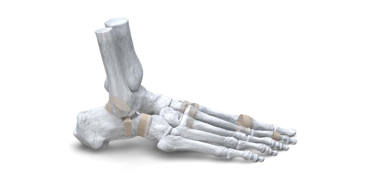 PRESERVE™ Bone and Biologic Solutions - Paragon 28