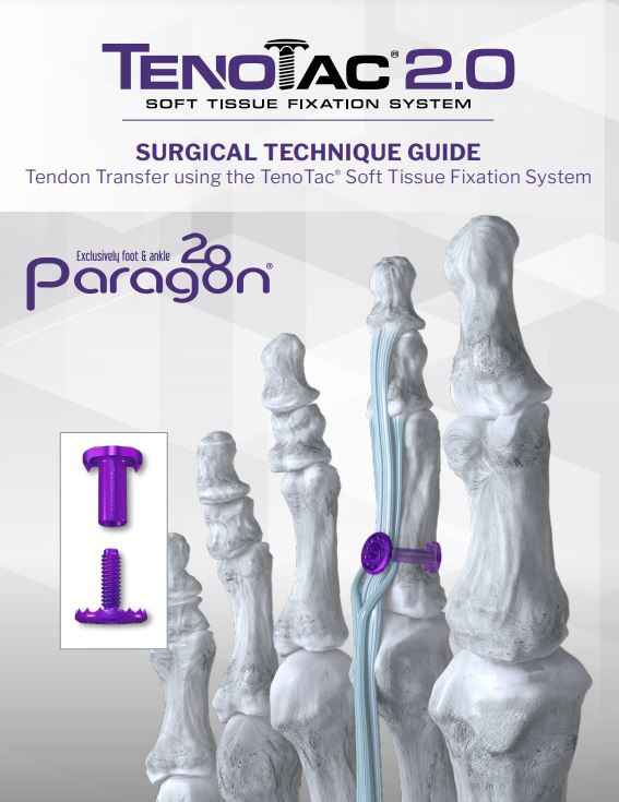 TenoTac® 2.0 Soft Tissue Fixation System - Paragon 28