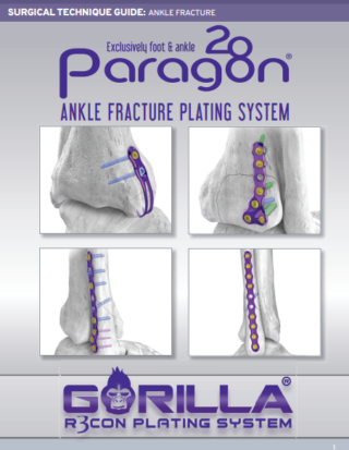 Surgical Technical Guides | Paragon 28