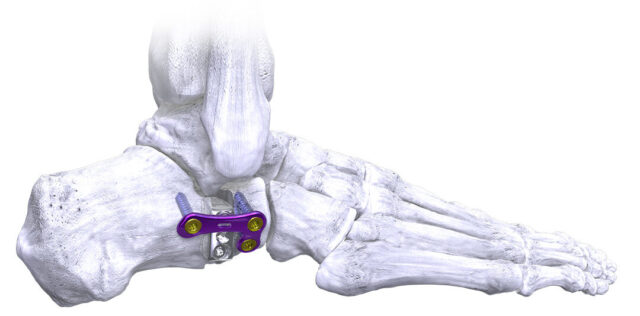 ADDITIVE ORTHOPAEDICS® Evans Lateral Column Lengthening Wedge – Paragon 28