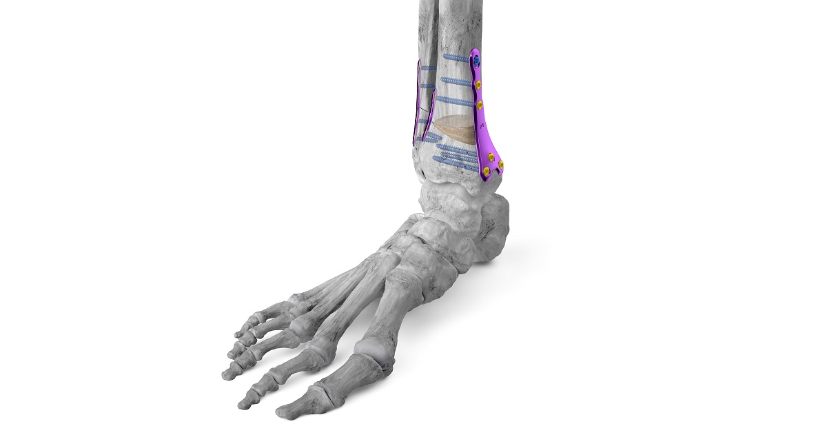 PRESERVE™ Supramalleolar Osteotomy Wedge – Paragon 28